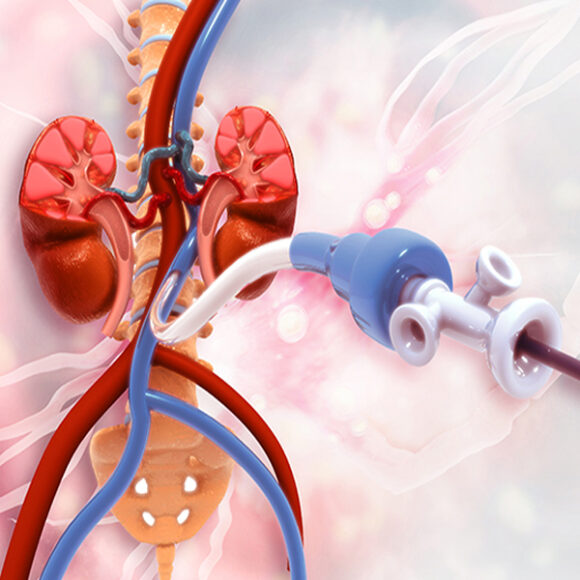 Permacath Procedure - DS Dialysis Center